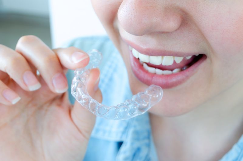 What Are Invisalign Refinements? How Do They Work?